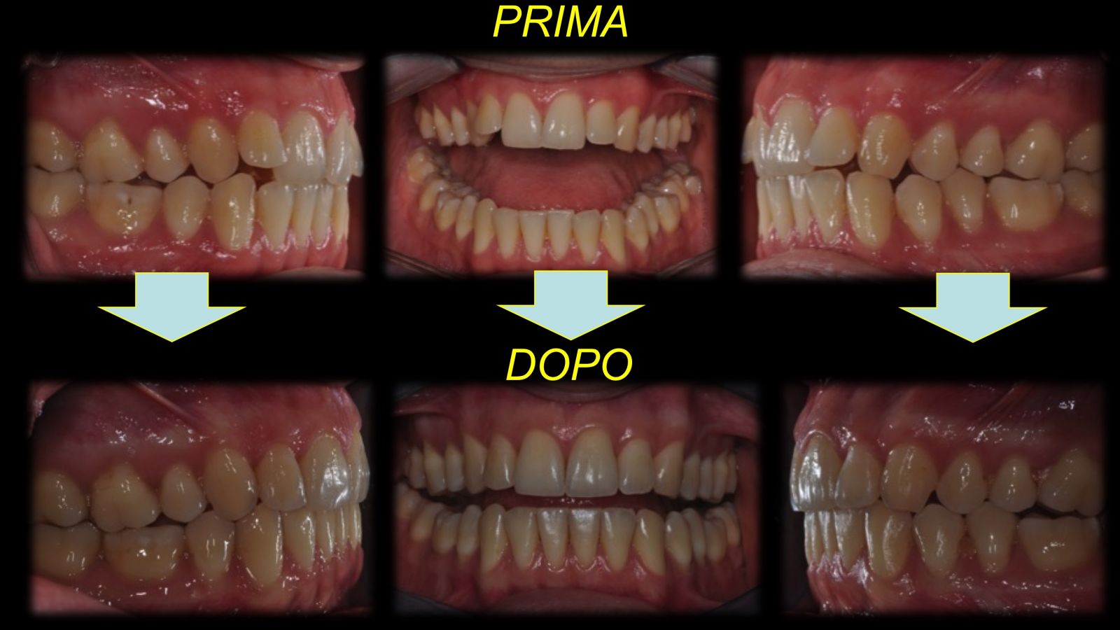Risultati Invisalign - Ortodonzia Invisalign Bologna